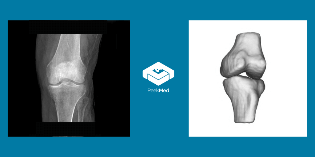 AI Conversion of Radiographs to 3D Bone Models With Successful Results