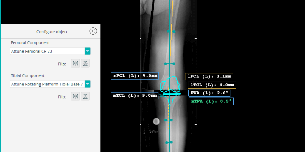 Total Knee Arthroplasty (TKA): How to plan and perform