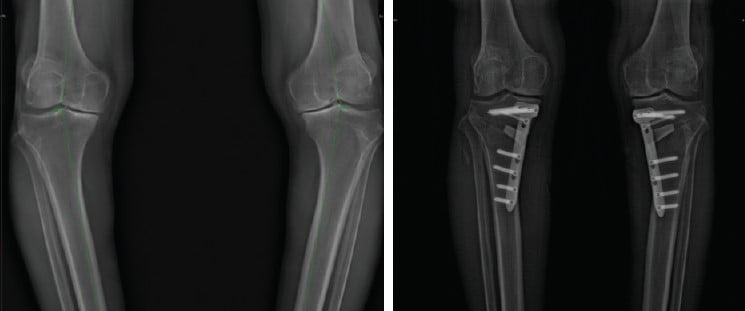 High Tibial Osteotomy: A Guide for Orthopedic Surgeons