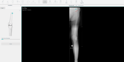 Total Knee Arthroplasty (TKA): How to plan and perform