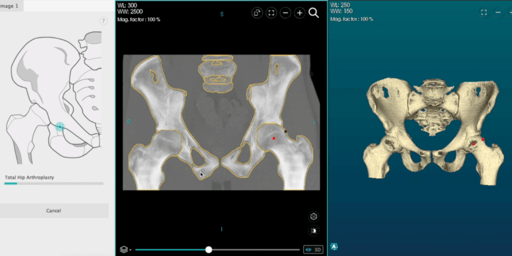 Total Hip Arthroplasty (THA): from planning to performing
