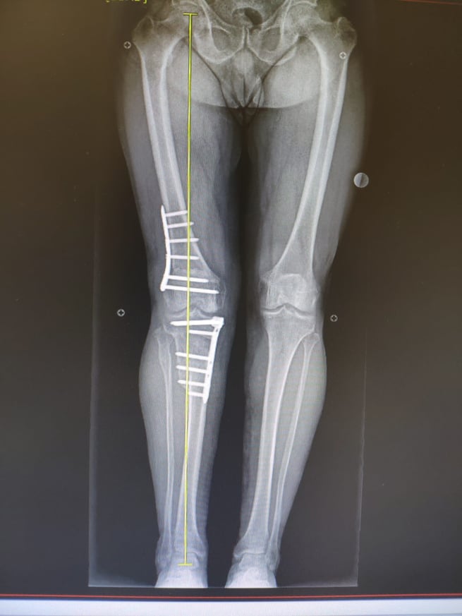 Double Osteotomy of the Knee: The Right Decision