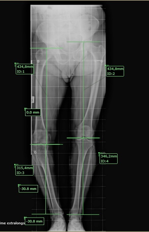 Double Knee Osteotomy: Why and how to do it [Case study]