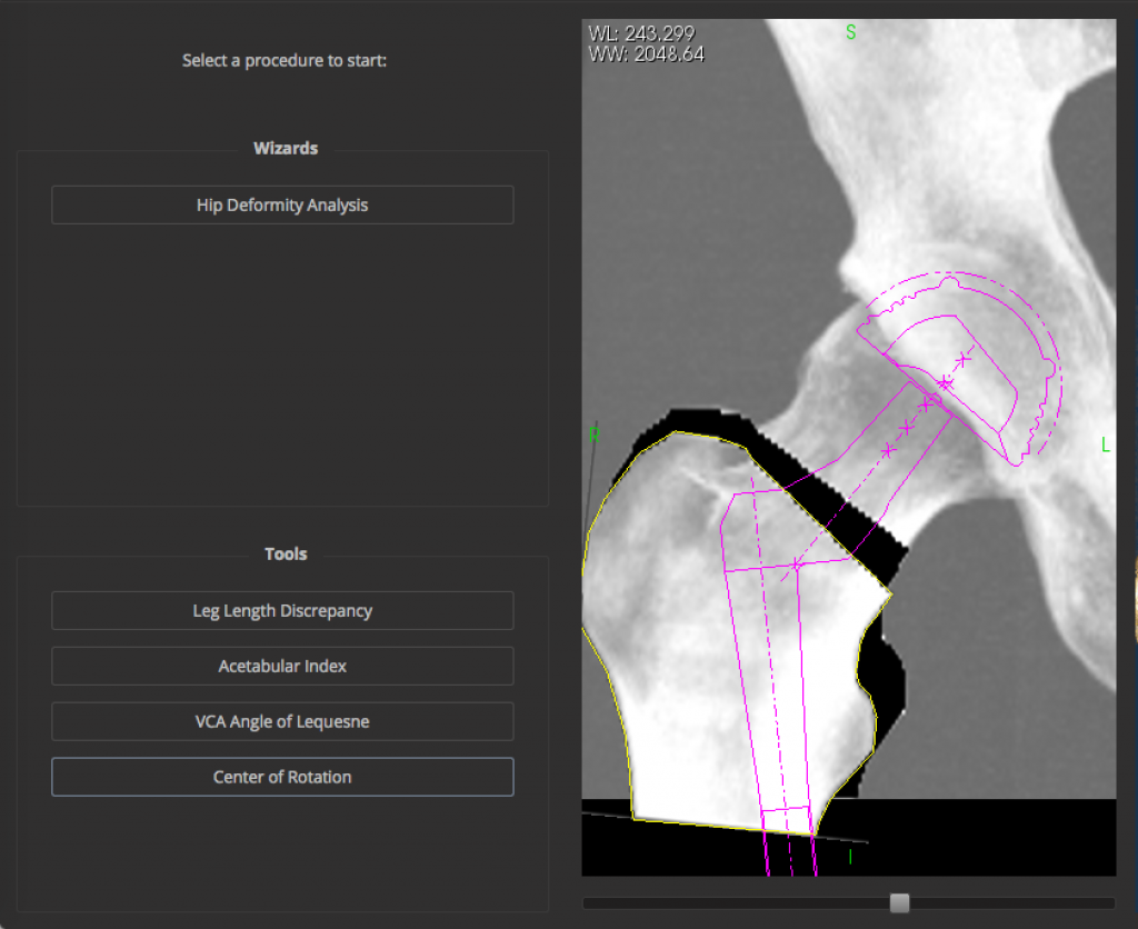 Hip Arthroplasty Templating: Improve the Procedure with a Digital Approach